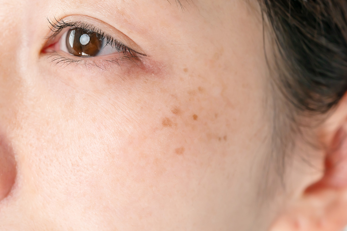 Dark Spots vs. Hyperpigmentation: The Differences and Treatments ...