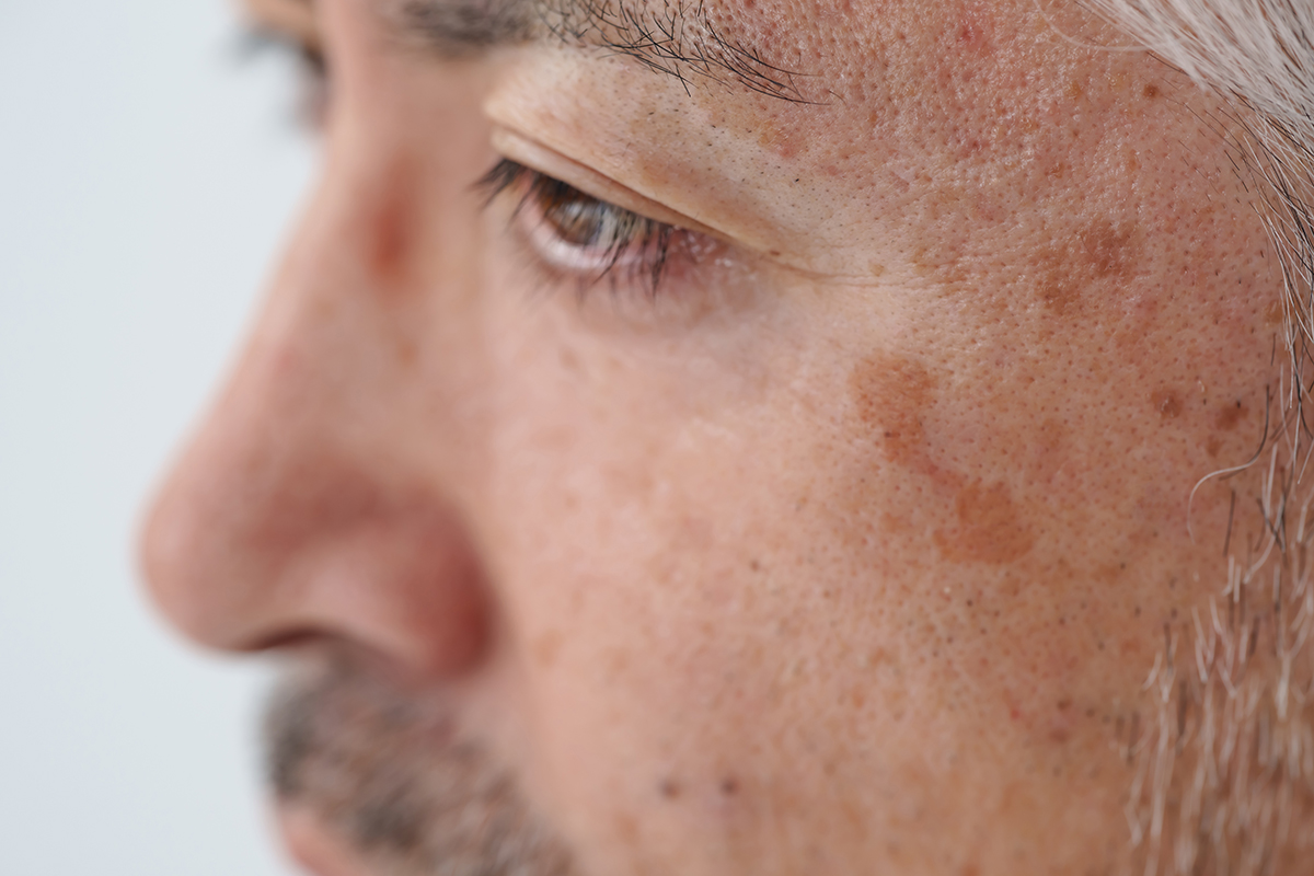 Dark Spots vs. Hyperpigmentation: The Differences and Treatments ...